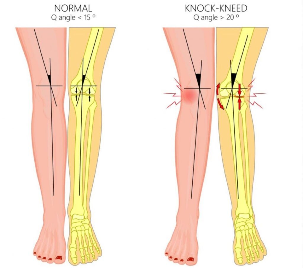 Knock Knees Exercise Before and After: Transform Your Alignment
